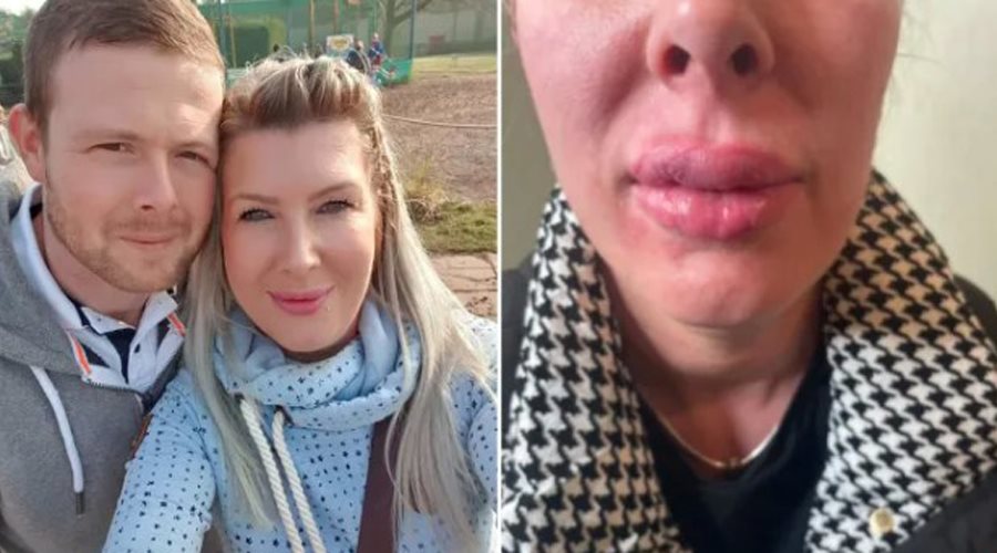 Ustnice so po posegu izgledale tako grozno, da je PREKLICALA poroko!